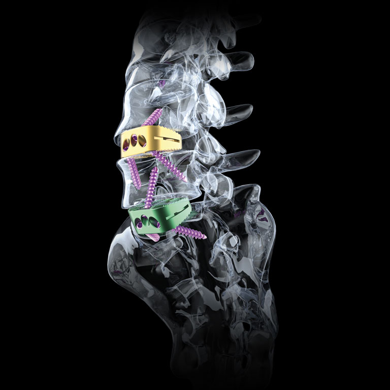 Spine | Biedermann Motech GmbH & Co. KG