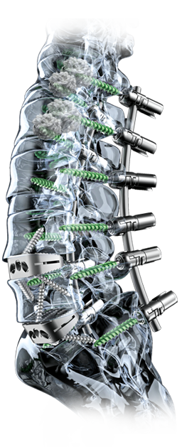 Spine | Biedermann Motech GmbH & Co. KG