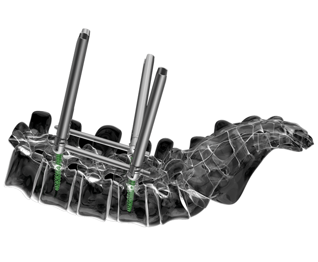 Spine | Biedermann Motech GmbH & Co. KG