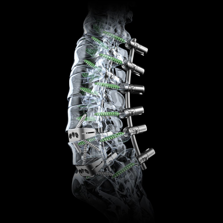 Spine | Biedermann Motech GmbH & Co. KG